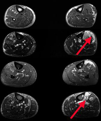 Radiologische Diagnostik bei peripheren Gefässmissbildungen | BV ...