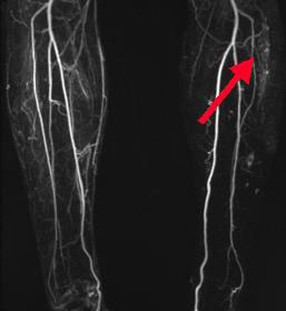 Radiologische Diagnostik bei peripheren Gefässmissbildungen | BV ...
