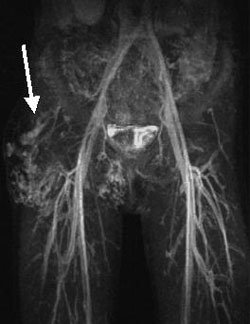 Radiologische Diagnostik bei peripheren Gefässmissbildungen | BV ...