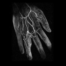 Radiologische Diagnostik bei peripheren Gefässmissbildungen | BV ...